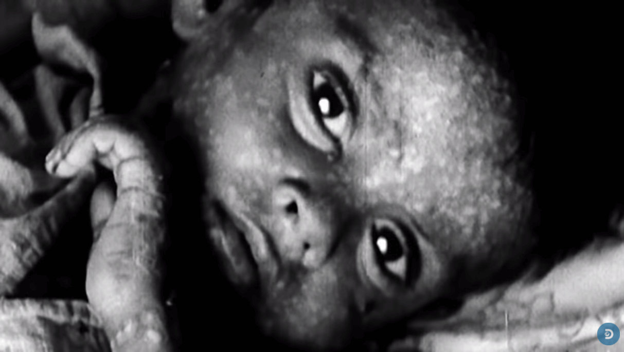 Smallpox Vaccine Scar
